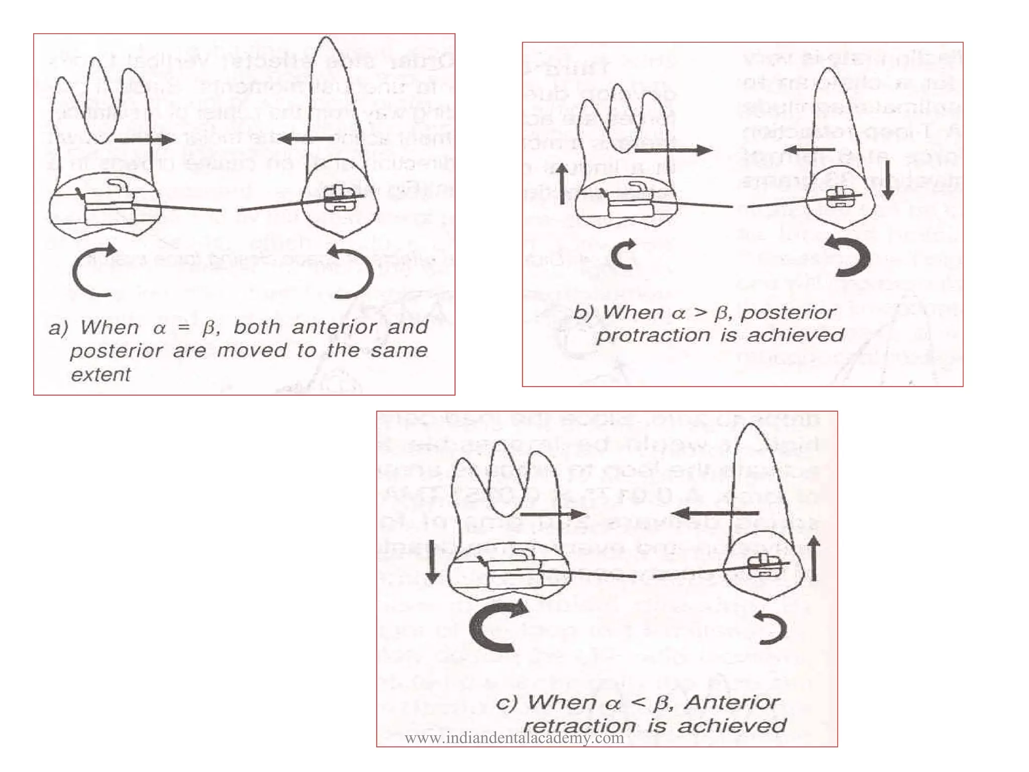Loops in orthodontics /certified fixed orthodontic courses by Indian ...