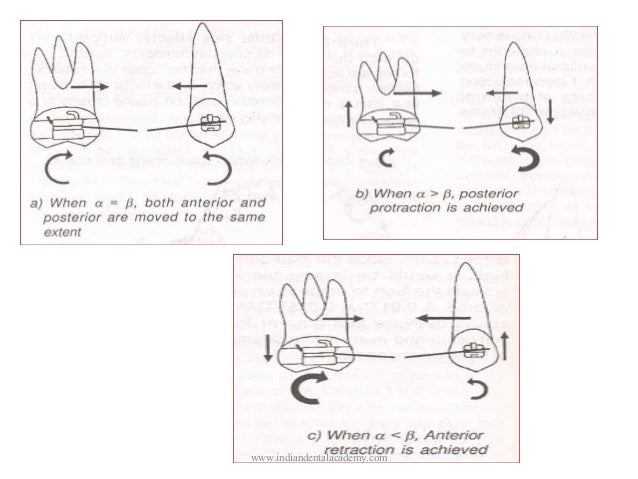 Loops In Orthodontics Certified Fixed Orthodontic Courses By Indian 