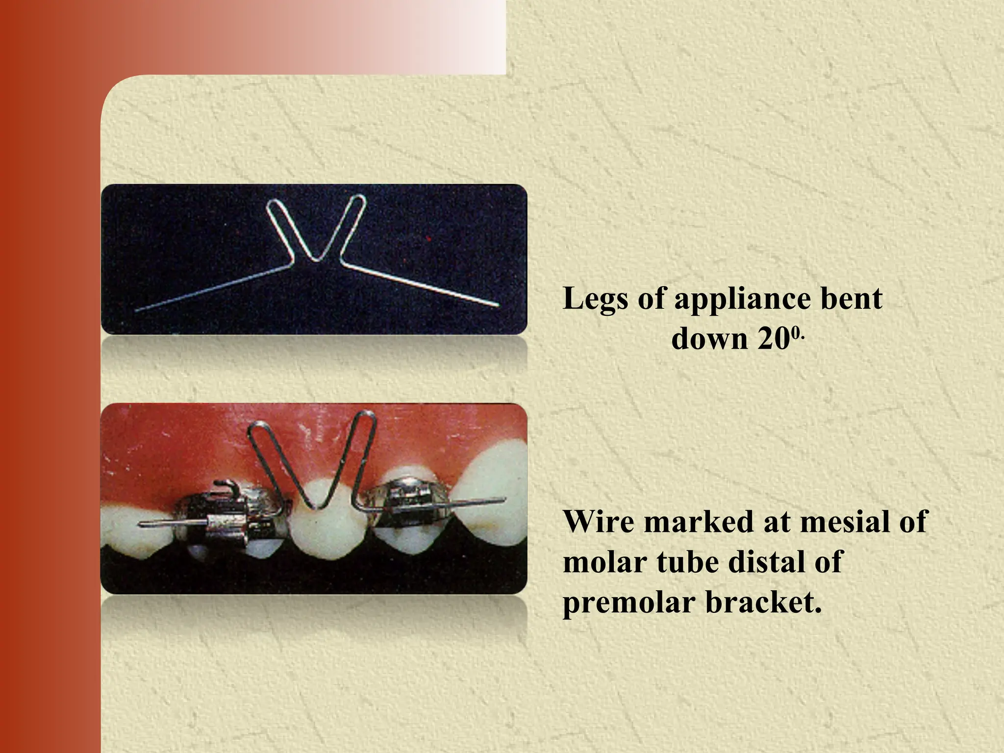 Loops in orthodontics and its uses [Autosaved]..ppt