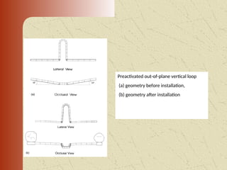 Loops in orthodontics and its uses [Autosaved]..ppt