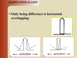 Loops in orthodontics and its uses [Autosaved]..ppt