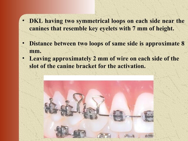 Loops in orthodontics and its uses [Autosaved]..ppt