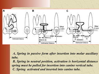 Loops in orthodontics and its uses [Autosaved]..ppt