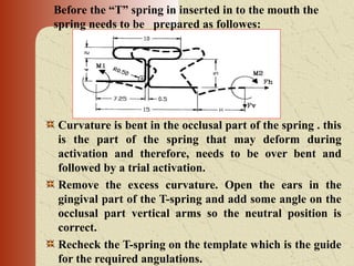 Loops in orthodontics and its uses [Autosaved]..ppt
