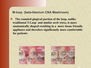 Loops in orthodontics and its uses [Autosaved]..ppt