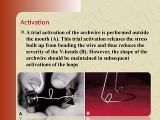 Loops in orthodontics and its uses [Autosaved]..ppt