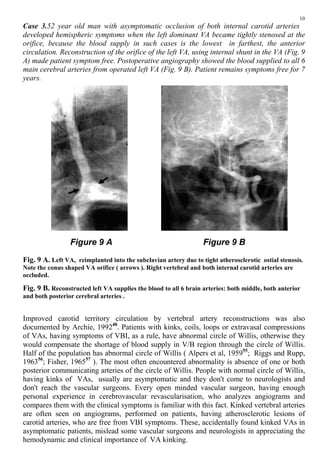 Loops Kinks and Anomalies of Vertebral Arteries | PDF