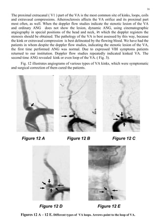 Loops Kinks and Anomalies of Vertebral Arteries | PDF