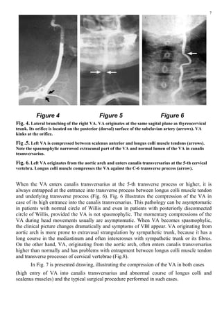 Loops Kinks and Anomalies of Vertebral Arteries | PDF