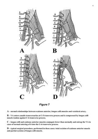 Loops Kinks and Anomalies of Vertebral Arteries | PDF