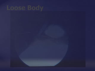 Loose Body Arthroscopy By Dr. Shekhar Srivastav | PDF