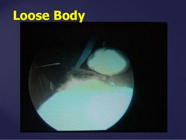 Loose Body Arthroscopy By Dr. Shekhar Srivastav