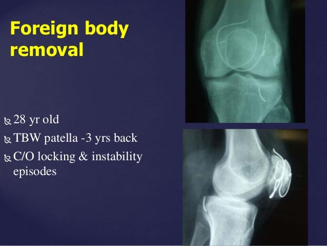 Loose Body Arthroscopy By Dr. Shekhar Srivastav