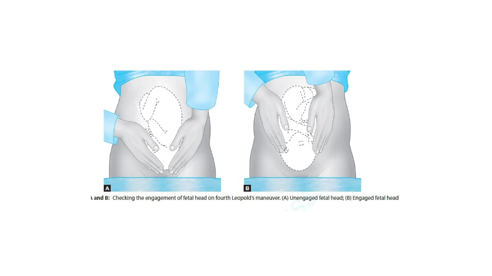 LOPOLD'S MANOEUVERS.pptx best of obs and gyn | PPT