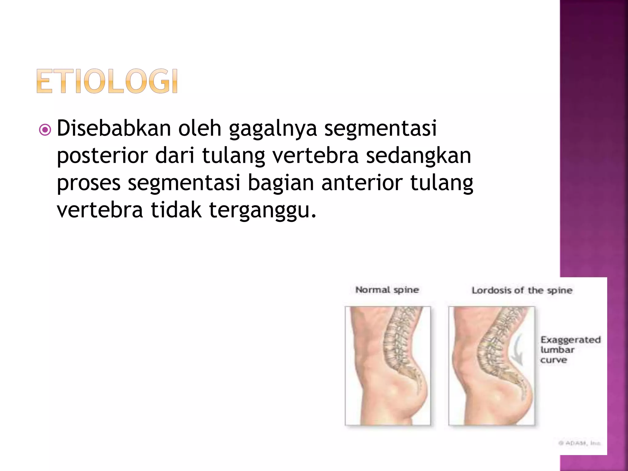 Lordosis shb | PPTX