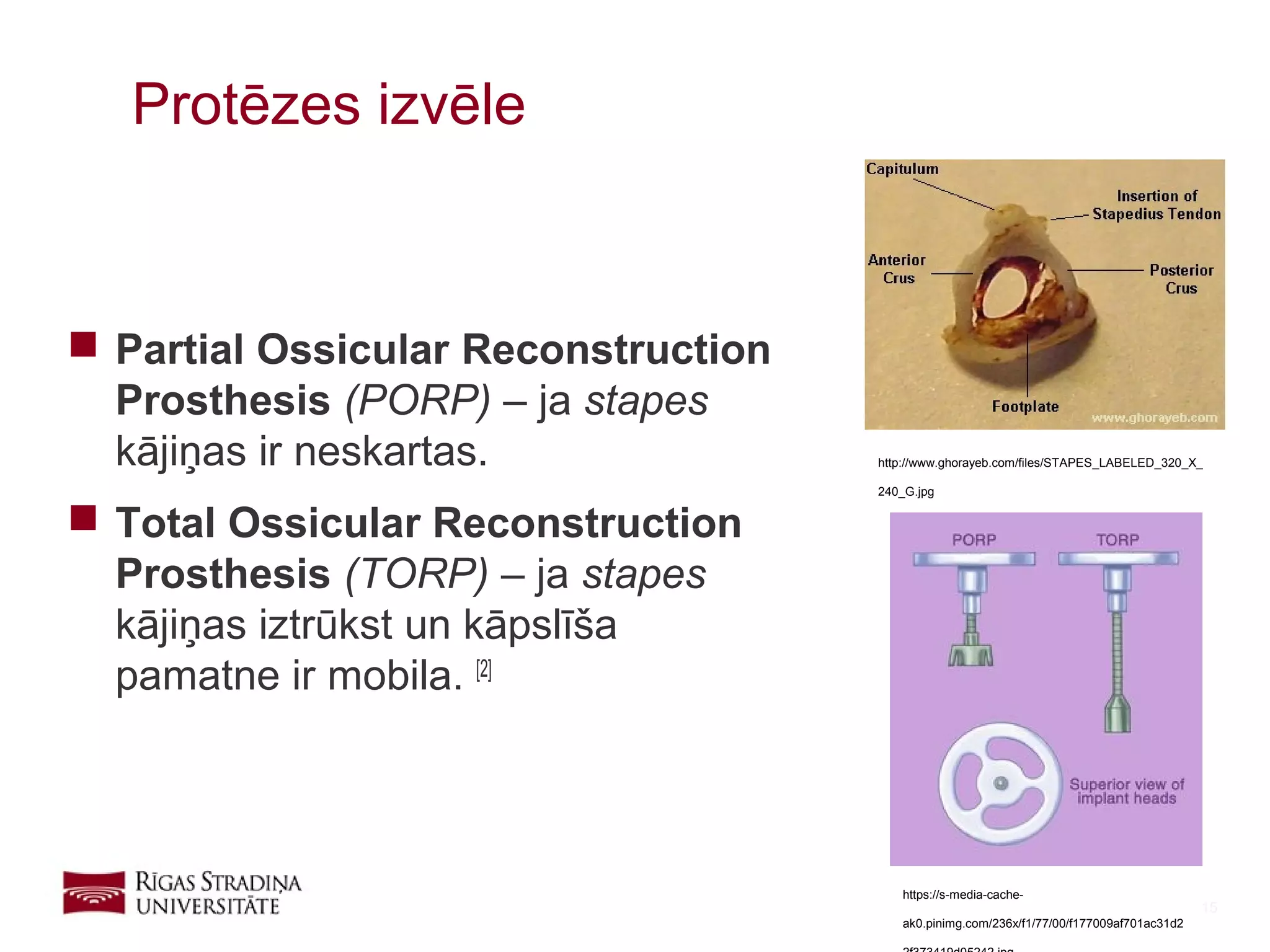 Ossikuloplastika | PPT