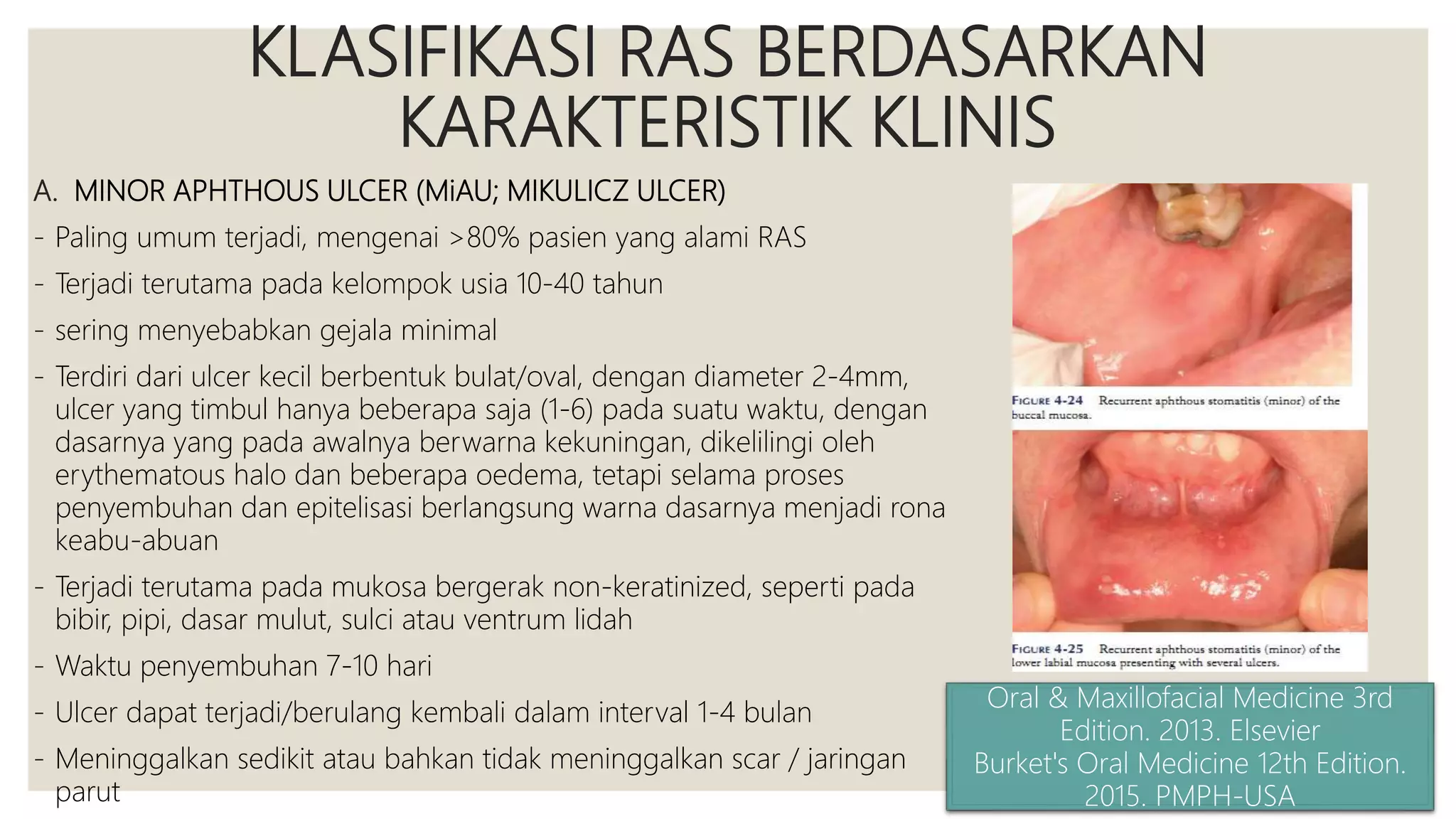 Reccurent Aphthous Stomatitis (RAS) / Stomatitis Aftosa Rekuren | PPTX