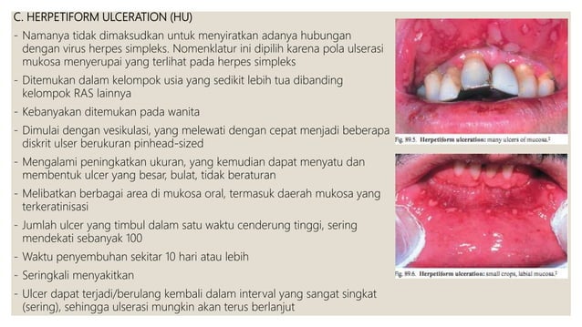 Reccurent Aphthous Stomatitis (RAS) / Stomatitis Aftosa Rekuren | PPTX