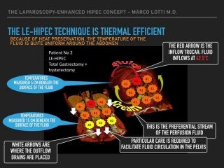 Lotti Marco MD - the Laparoscopy-Enhanced HIPEC Concept | PPT