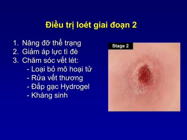 LOÉT TÌ ĐÈ Ở NGƯỜI CAO TUỔI | PDF