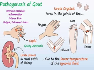 GOUT | PPTX | Hormonal Disorders | Endocrine and Metabolic Diseases