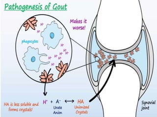 GOUT | PPTX | Hormonal Disorders | Endocrine and Metabolic Diseases
