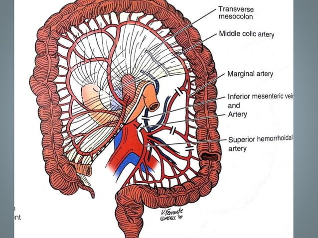 Low Anterior Resection | PPTX | Surgery | Medical Health