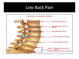 Low back dysfunction for acute and chronic injuries | PPTX