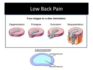 Low back dysfunction for acute and chronic injuries | PPTX