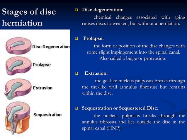 Lowback injuries | PPT