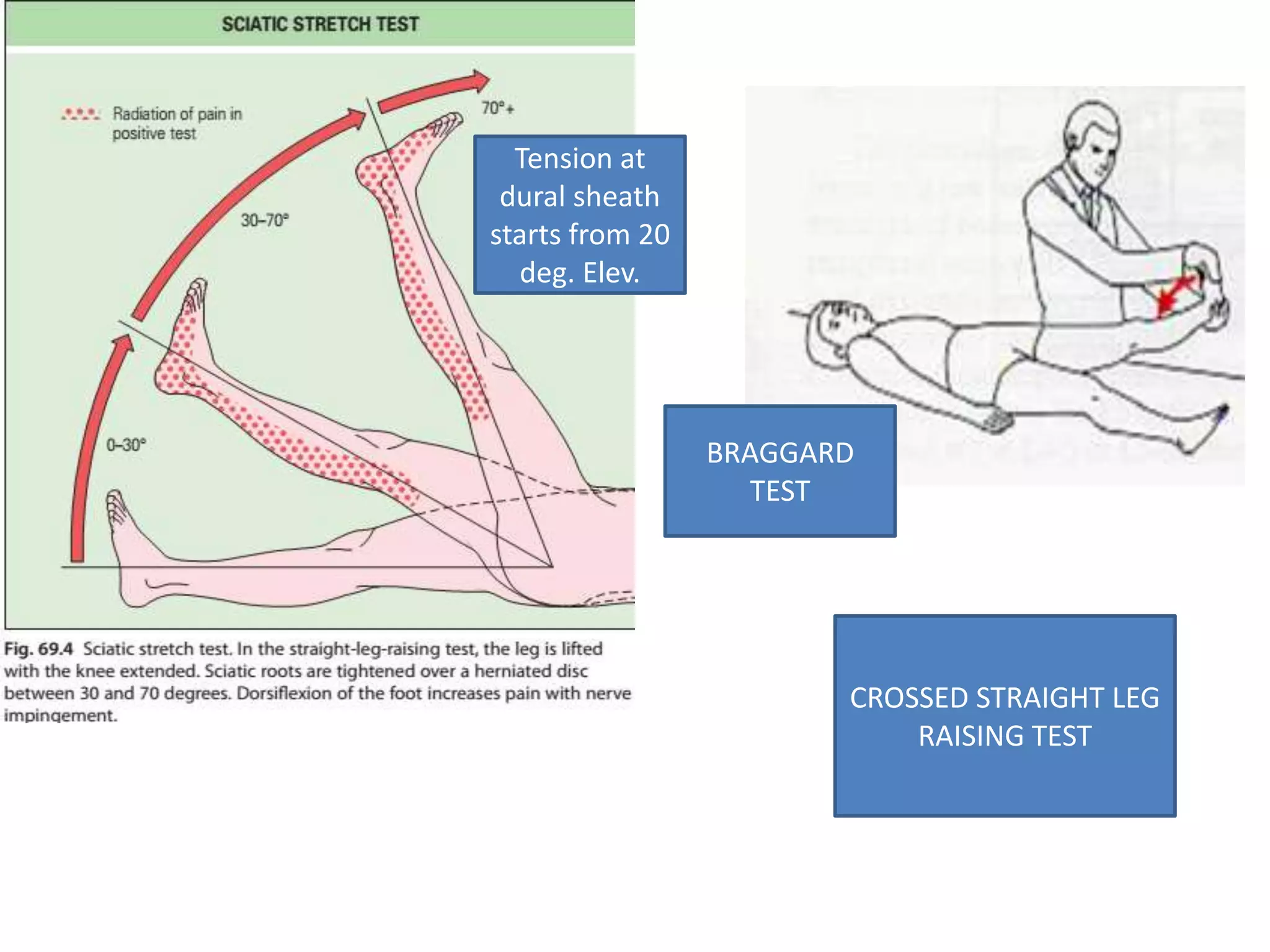 Low back pain | PPTX