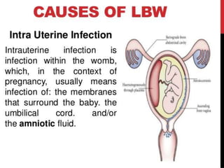 Low Birth Weight Baby-PPT.pptx