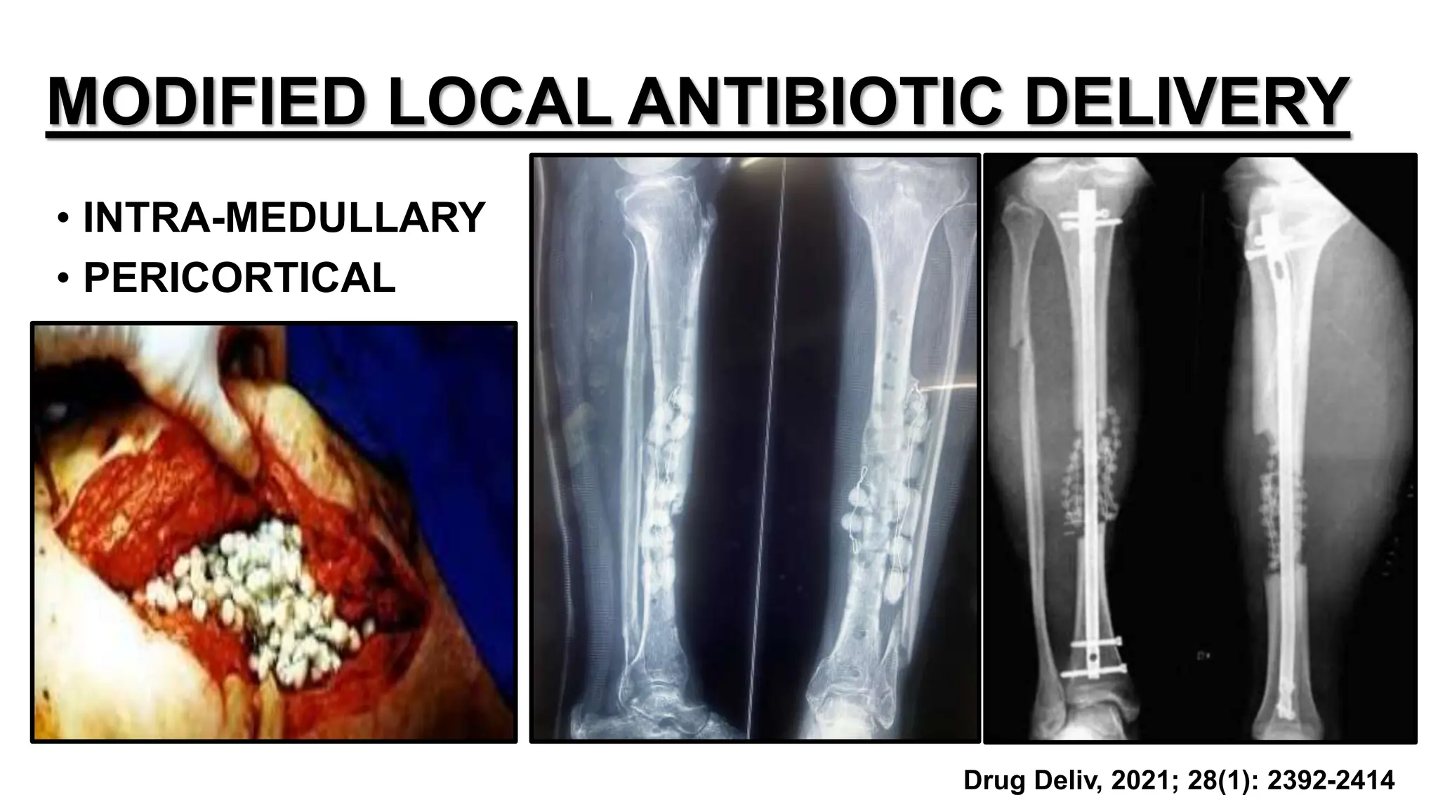 low cost antibiotic cement nail for infected non union.pptx