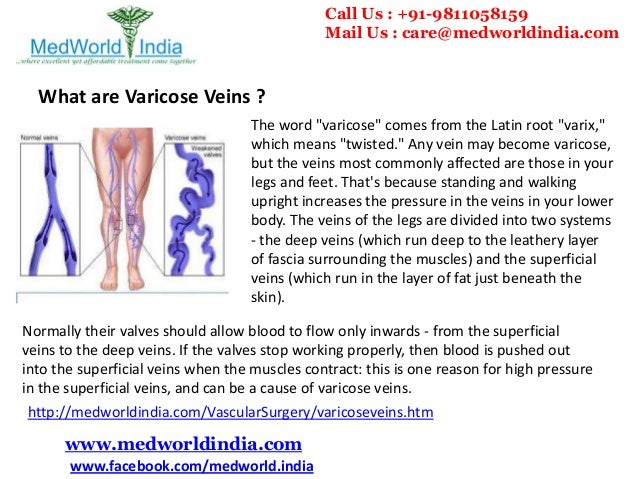 Low Cost Varicose Veins Treatment In India