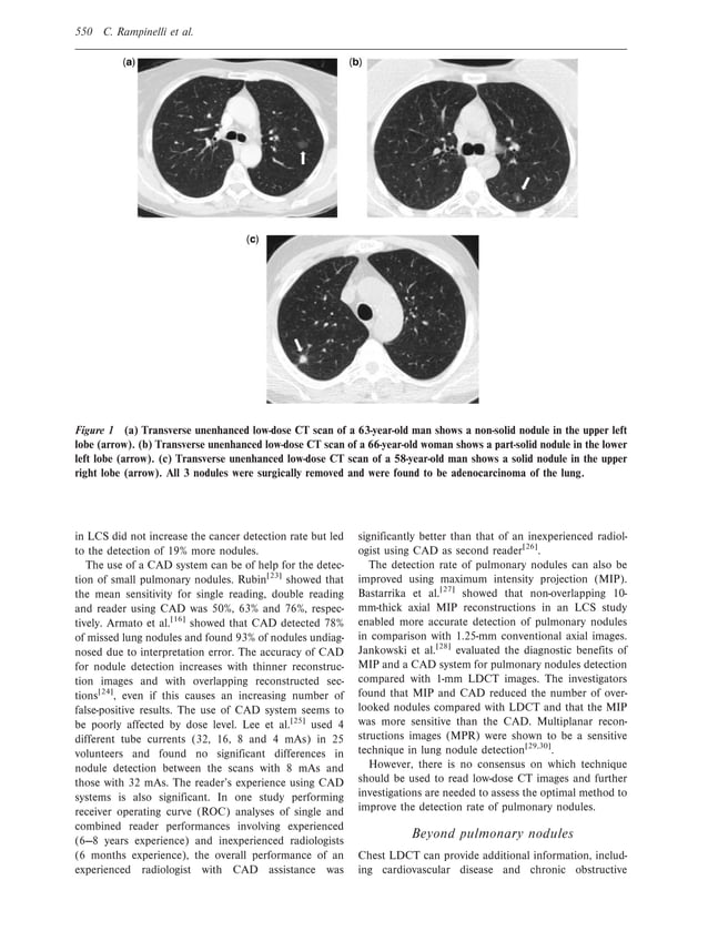 low dose CT.pdf | Lung and Respiratory Health | Diseases and Conditions