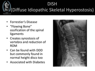 Patient is 63 year old with “stiffening” LB ache and Type I DM | PPTX