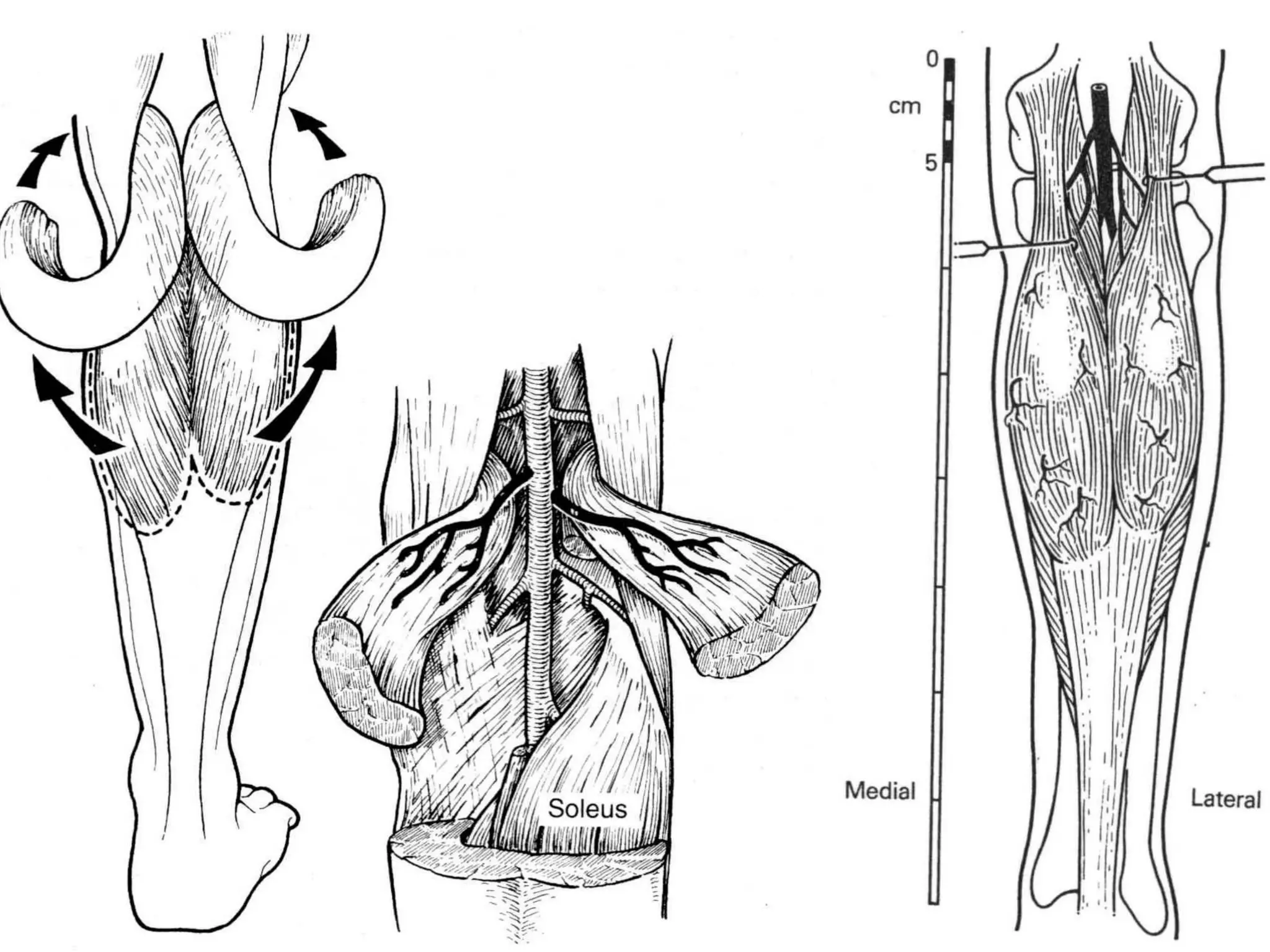 Lower limb-flaps | PPT