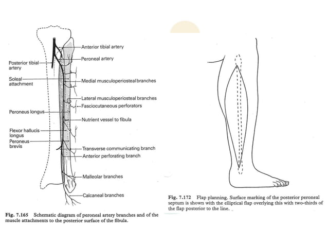 Lower limb-flaps | PPT