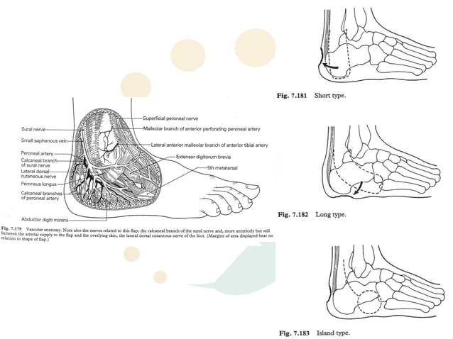 Lower limb-flaps | PPT