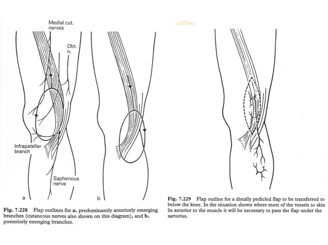 Lower limb-flaps | PPT
