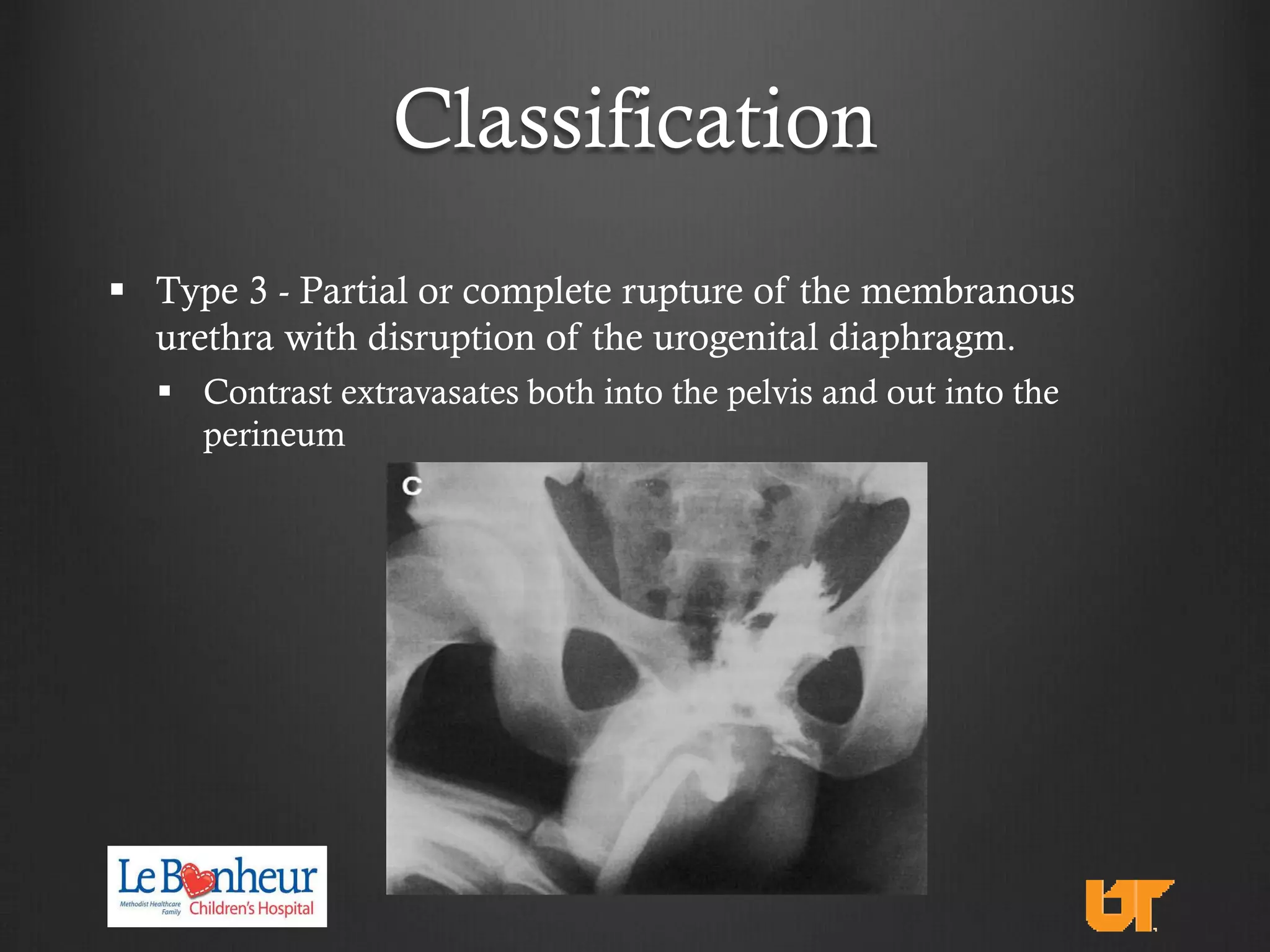 Lower urinary-tract-trauma-in-the-setting-of-pelvic-fractures | PDF