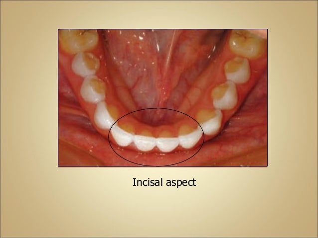 Lower Central & Lateral Incisor
