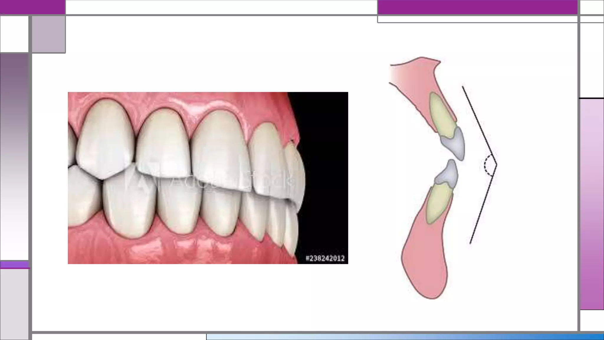 Mandibular central & lateral incisors | PPTX