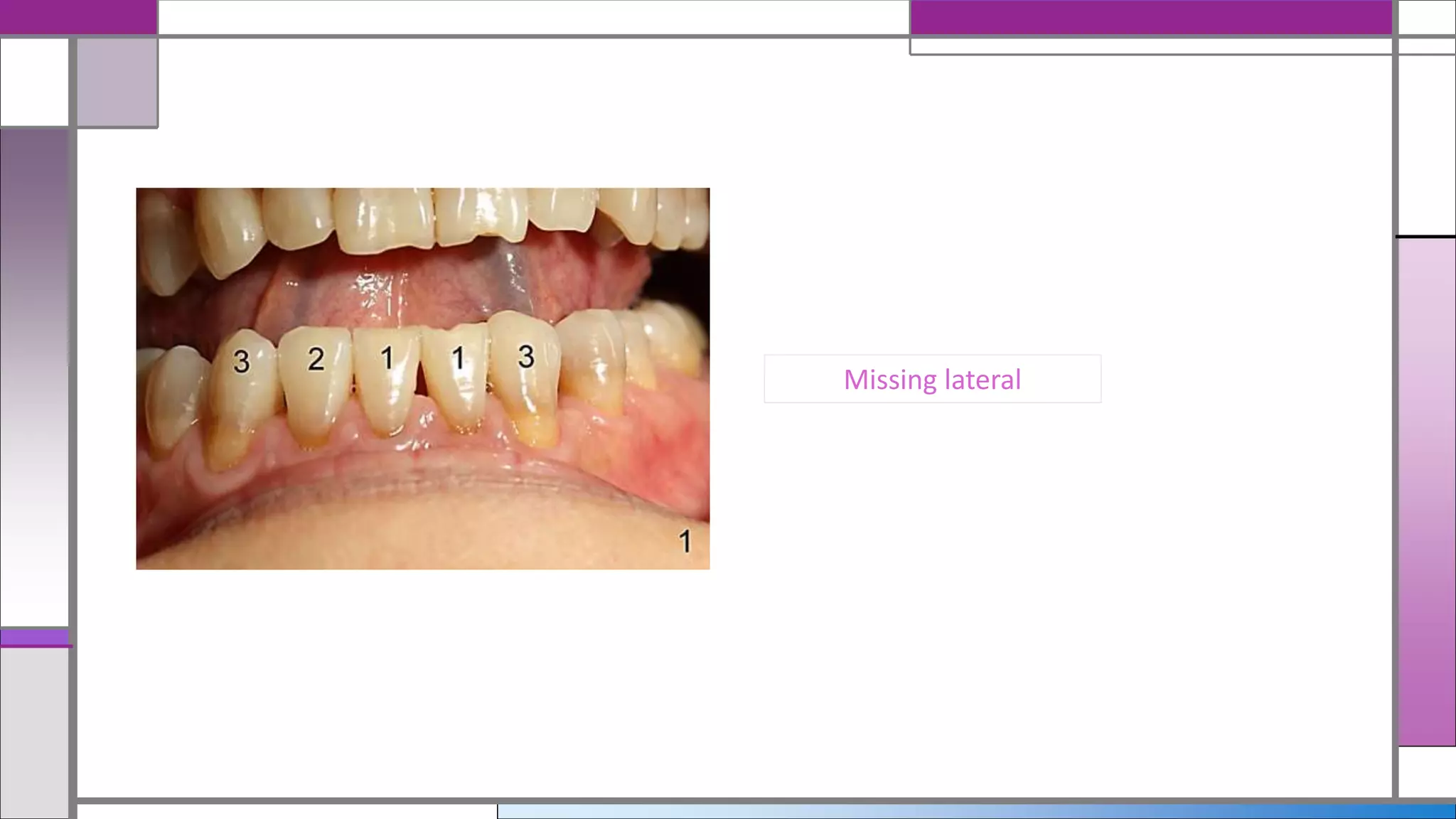 Mandibular central & lateral incisors | PPTX