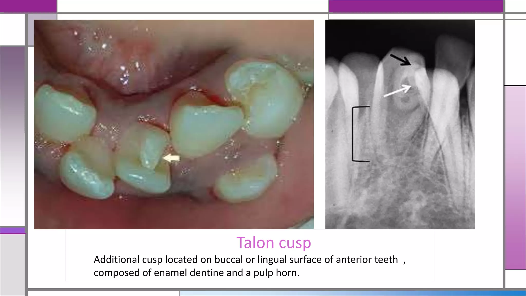 Mandibular central & lateral incisors | PPTX