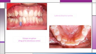Mandibular central & lateral incisors | PPTX