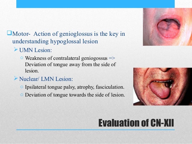 Disorder of lower cranial nerves