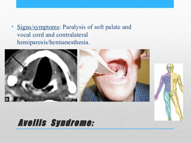Disorder of lower cranial nerves