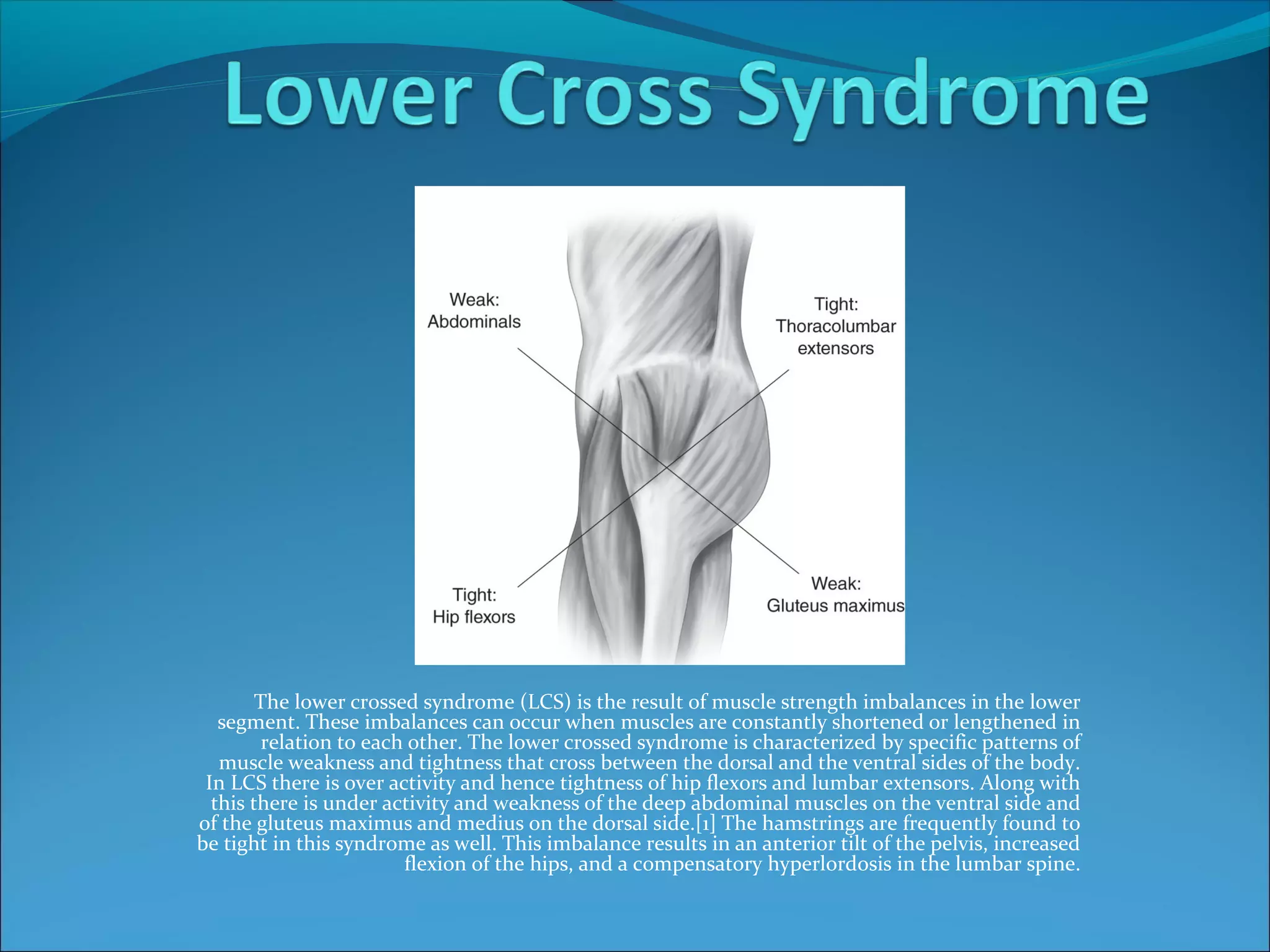 Lower cross syndrome | PPT