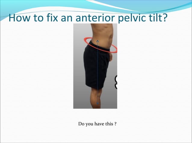 Lower cross syndrome | PPT